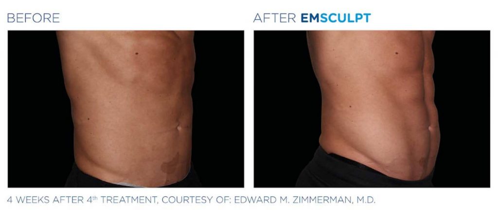 Emsculpt Before and After | Real Patient Results