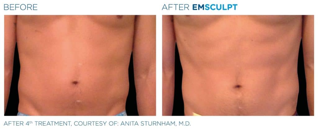 Emsculpt Before and After | Real Patient Results