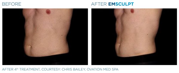 Emsculpt Before and After | Real Patient Results