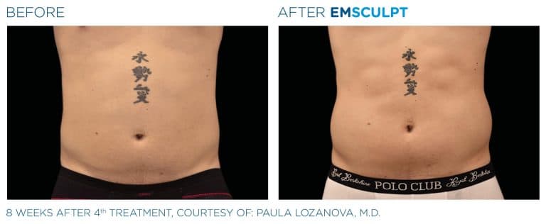 Emsculpt Before and After | Real Patient Results