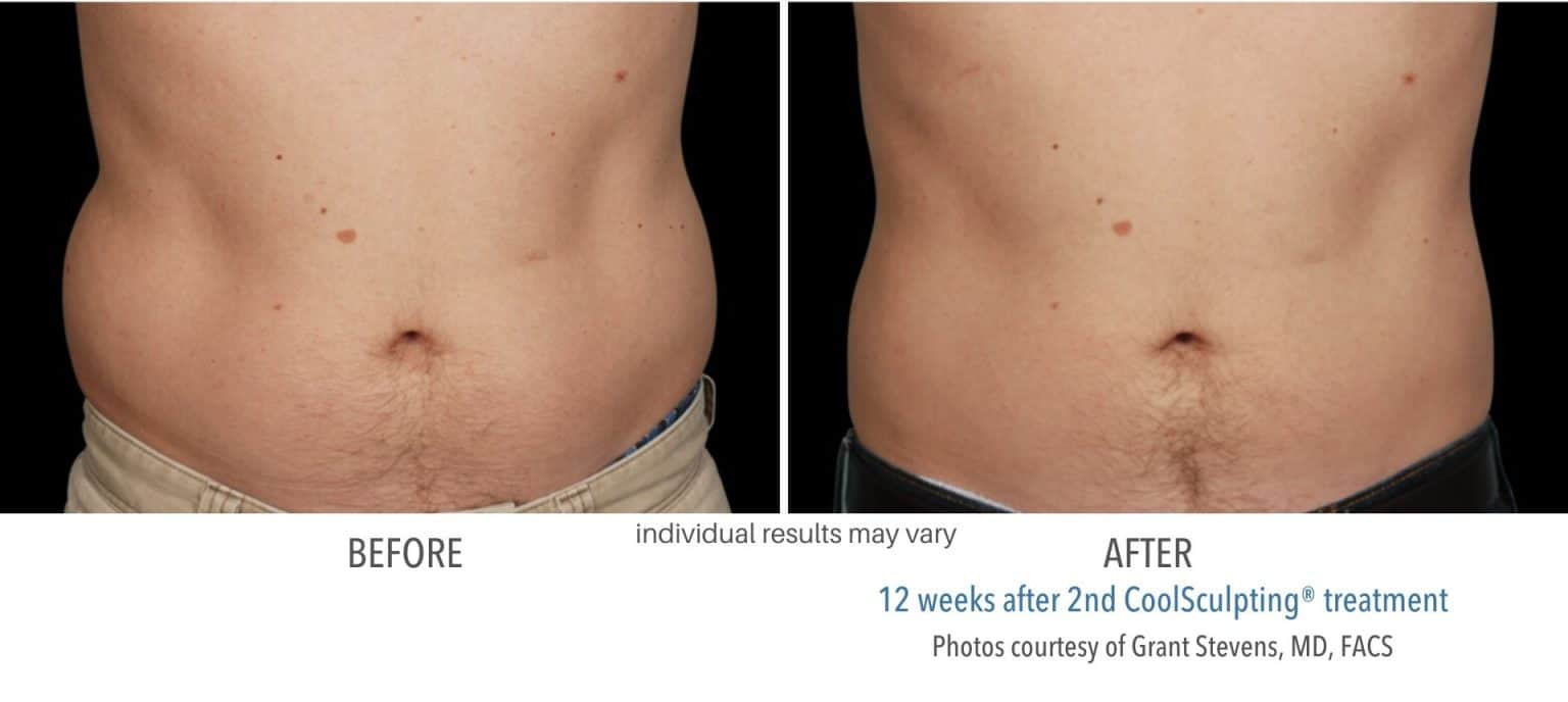 Coolsculpting For Men Safe Non Invasive Alternative