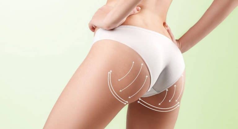 Emsculpt Neo Butt Lifts Explained With Before After Pictures