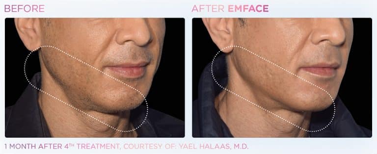 BTL Emface Before-And-After Pictures | Greater Boston, MA