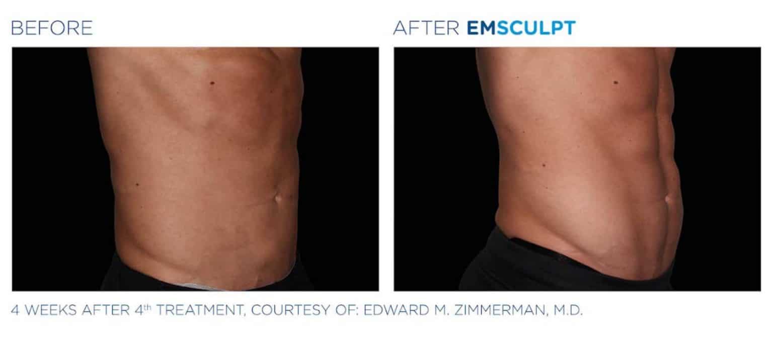 Introducing the Emsculpt NEO Edge Applicator for Defined Abs